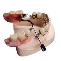 China Mk1 Precision Attachment Denture Beautiful Natural Corrosion Resistant for sale