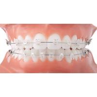 China Easy Clean Orthodontic Ceramic Bracket Beautiful Fixed Orthodontic Appliances for sale