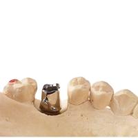 China Milling Process Pure Titanium Abutment Implants Durable Good Biocompatibility for sale