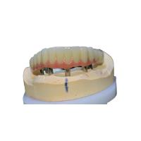 China Easy Cleaning Dental Implant Crown Comfortable No Foreign Body Sensation for sale
