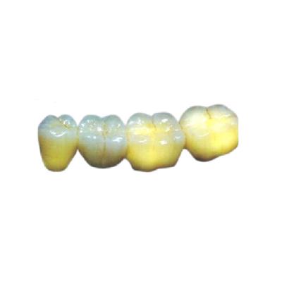 China Wear Resistant PFM Dental Crown High Strength Aesthetic Allergy Friendly for sale