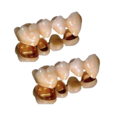 China Palladium Porcelain Dental Crown Excellent Ductility Corrosion Resistant for sale