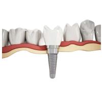China Durable Titanium Dental Implant High Biocompatibility Corrosion Resistant for sale