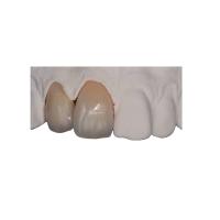 China Body Strength Thin Zirconia Crown Durable Natural Realistic Restoration for sale