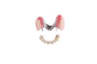 China FILLED REMOVABLE DENTURES CROWN INVISIBLE TEMPORARY OVERDENTURES DENTURE PROCESSIN for sale