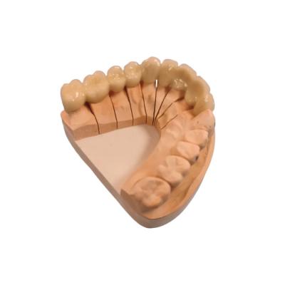 China High Strength Metal Porcelain Crown PFM Dental Crown Color Stable Smooth Surface for sale
