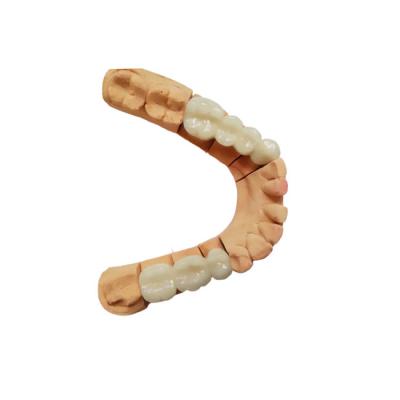 China High Quality PFM Dental Crown Realistic Appearance Color Stable Not Easy To Wear for sale