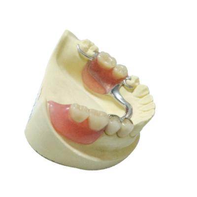 China Steel Removable Partial Dentures Denture Restoration Dental Lab Products for sale