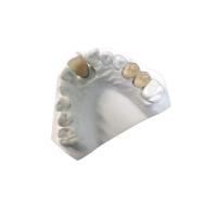 China Yellow Gold Porcelain Dental Crown OEM High Strength New Condition for sale