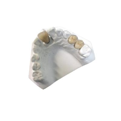 China Yellow Gold Porcelain Dental Crown OEM High Strength New Condition for sale