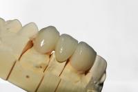 China Beautiful Dental Crown Bridge Wear Natural Restore Chewing Power for sale