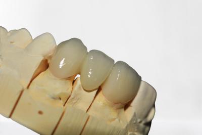 China Good Stability Dental Crown Bridge Clean And Tidy High Quality Clean And Tidy for sale