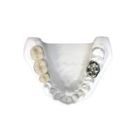 China The Color Of The Porcelain Crown Is Stablenot And Has Strong Stability for sale