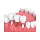 China Comfortable Dental Crowns And Bridges Strong Wear Resistance Make Smile Sweeter for sale