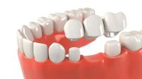 China OEM Dental Crown Bridge Good Biocompatibility Smooth Surface Make Smile Sweeter for sale