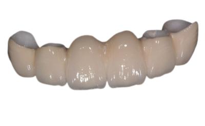 China Smooth Surface Porcelain Dental Crown Restore Chewing Power Good Stability for sale