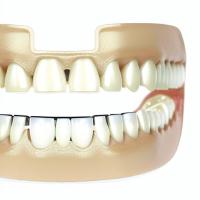 China Ergonomic Roth Fixed Orthodontic Appliances For B2B Buyers for sale