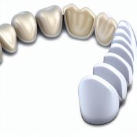 China High Quality Ergonomic Fixed Orthodontic Appliances With 0.018 0.022 Bracket Slot And 0.022 Tie Slot for sale