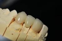 China Customized Zirconia Denture Dental lab - Fast Delivery and Repair for sale