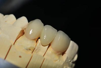 China Customized Zirconia Denture Dental lab - Fast Delivery and Repair for sale