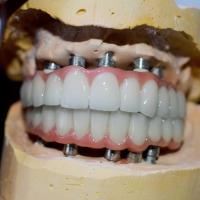 China The Journey To A Healthy Smile Our Dental Implant Crown Process for sale