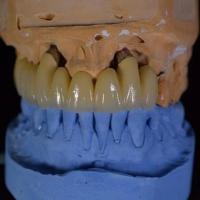 China Strong Transparency Ceramic Dental Crown Good Abrasion Resistance Long-lasting for sale