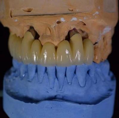 China Strong Transparency Ceramic Dental Crown Good Abrasion Resistance Long-lasting for sale