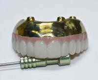 China Full Zirconia Bridge With Titanium Bar Support, Long-lasting Titanium Bar Supported Zirconia Crowns With Bridges for sale