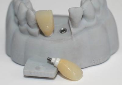 China Corrosion Resistant CAD PEEK Custom Abutment Designed To Improve Implant Longevity And Patient Comfort In Dental Treatments for sale