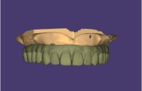 China Design AOX Professional Full Arch Implant Bridge Design Service for sale