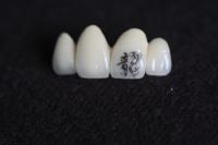 China PFM Dental Crown Image Customization with personalized customized patterns for sale