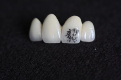 China PFM Dental Crown Image Customization with personalized customized patterns for sale