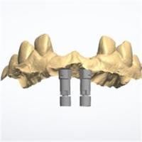 China Customized 3D Model Zirconia Crown Offering Long-lasting Durability Designed To Meet The Needs Of Dental Professionals And Laboratories for sale