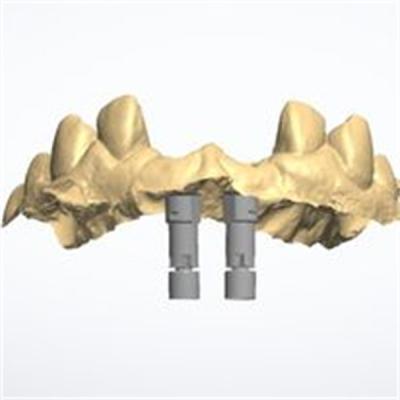 China Customized 3D Model Zirconia Crown Offering Long-lasting Durability Designed To Meet The Needs Of Dental Professionals And Laboratories for sale
