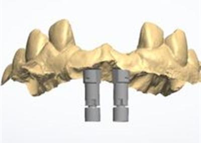 China Natural-looking Zirconia Dental Crown with Excellent Biocompatibility and Cementable 3D Model for sale