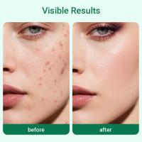 China Anti Acne Ceramide NP Sodium Hyaluronate Facial Skincare Set 1000pcs Black Spot Whitening for sale