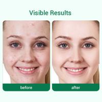 China Acne Control Alpha Arbutin Niacinamide Salicylic Acid Face Serum 30ml OEM ODM for sale