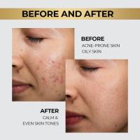 China OEM ODM Brand ExosomeFacial Serum essence Nicotinamide Anti aging Acne Control Centella B5 AHA+BHA+PHA Pore Shrinkage Oil Skin Care Serum for sale