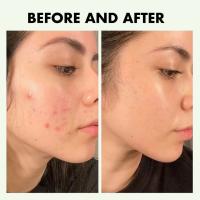 China OEM ODM Organic Cleansing gel Mild Moisturizing Makeup Removing Acne Skin Friendly Cleansing Jelly Cleanser for sale