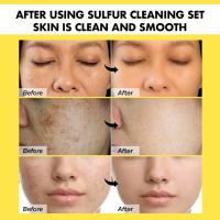 China OEM ODM Brand Customized Sulfur Facial Cleanser for Acne Treatment, Pore Tightening, Oil Control, and Facial Whitening for sale