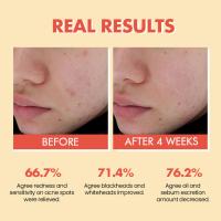China OEM ODM brand organic natural skin care essence product to repair sensitive redness, swelling, acne, treat and soothe women's face essential oil for sale