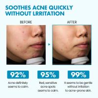 China OEM ODM Brand Acne Treatment Serum Acne Alleviation Spot Improvement Facial Cuticle Layer Solution Skin Texture AHA PHA BHA Exfoliating Facial essence for sale