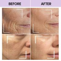 China OEM ODM Natural Pure essence Repairing Acne Treatment Soothing Sensitive Skin Care Facial essence Facial essence Serum for sale