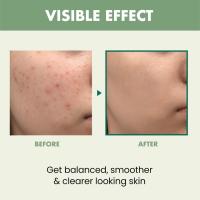 China OEM ODM customized private brand skin care gel effective and fast acne removing tea tree oil acne scar removing gel for sale