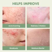 China OEM ODM customized private brand skin care gel effective and fast acne removing tea tree oil acne scar removing gel for sale