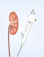 China Disposable electronic pyeloscopy with low cost and convenient operation  smart disposable electronic pyeloscopy for sale