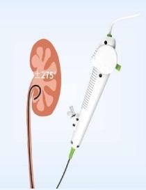 China Disposable electronic pyeloscopy with low cost and convenient operation  smart disposable electronic pyeloscopy for sale