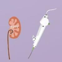 China Disposable electronic pyeloscopy with low cost and convenient operation  smart disposable electronic pyeloscopy for sale