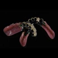 China Aesthetic Precision Dental Implant Ball Attachment Partial Dentures for sale