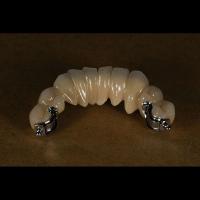 China Aesthetic Precision Dental Implant Ball Attachment Partial Dentures for sale